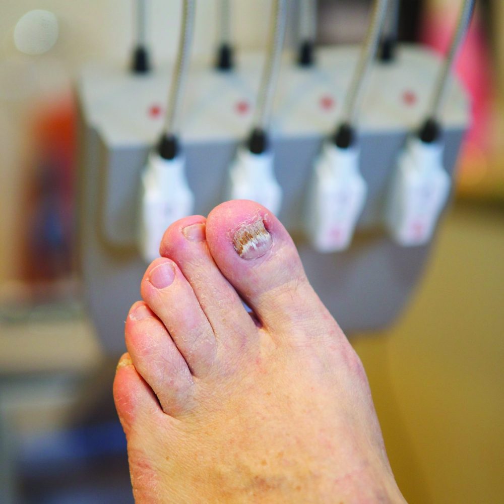 Dermatophyte testing service in Amersham, Bucks Area - Bucksfoot Clinic