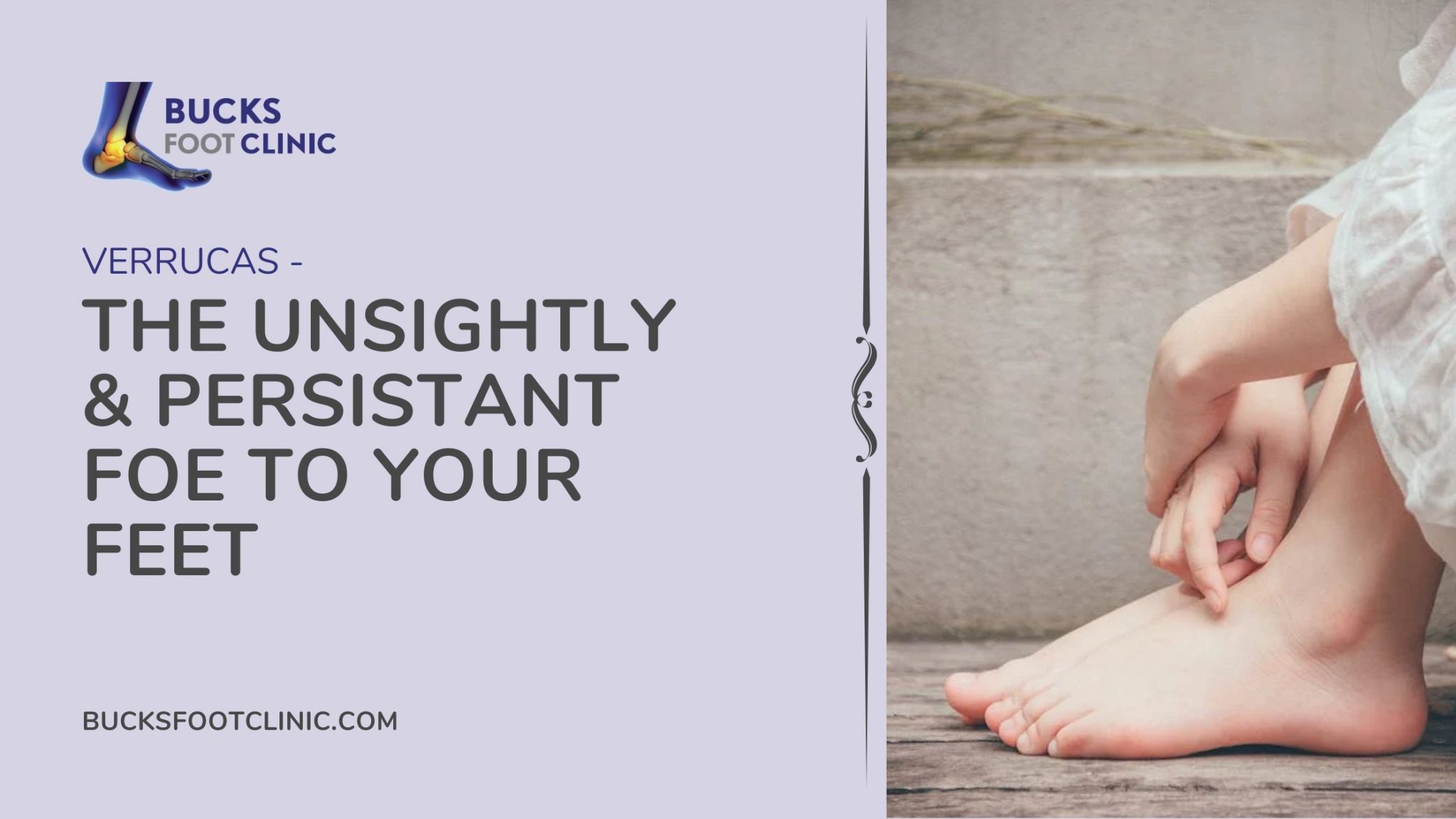 Verrucas The unsightly persistant foe to your feet