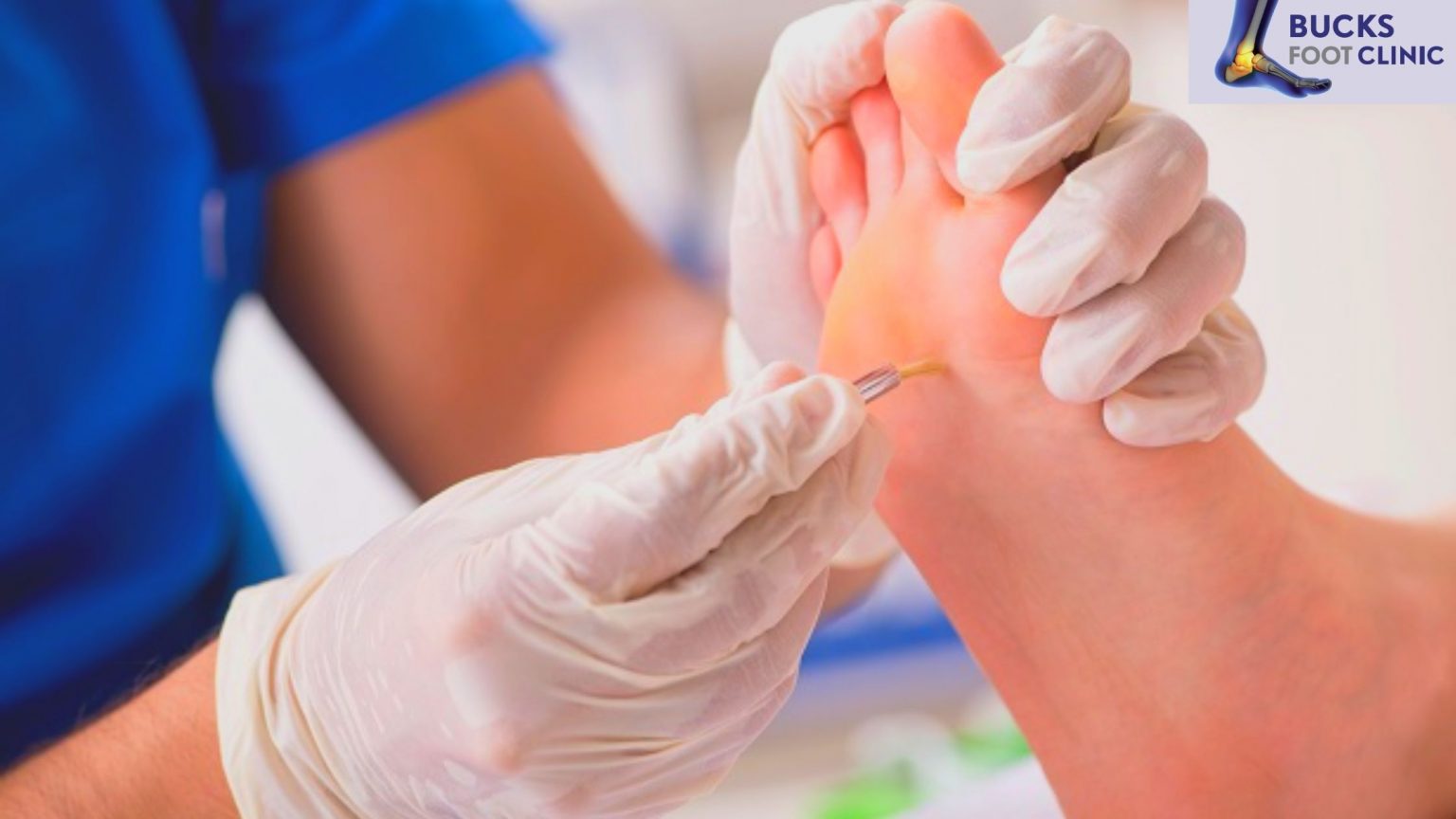 Foot Corn Treatment & Callus Removal for the Elderly