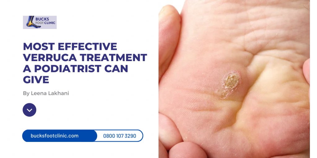 Most Effective Verruca Treatment A Podiatrist Can Give