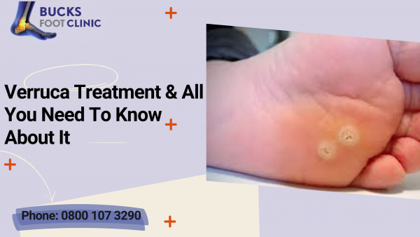 Verruca Treatment & All You Need To Know About It
