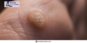 Why Do Verrucas Hurt & How Do I Treat Them?