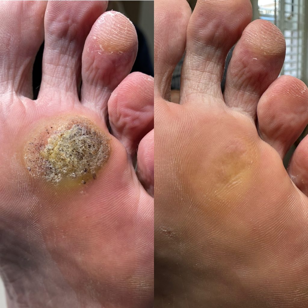 Verruca & Wart Removal Treatment - Bucks Foot Clinic