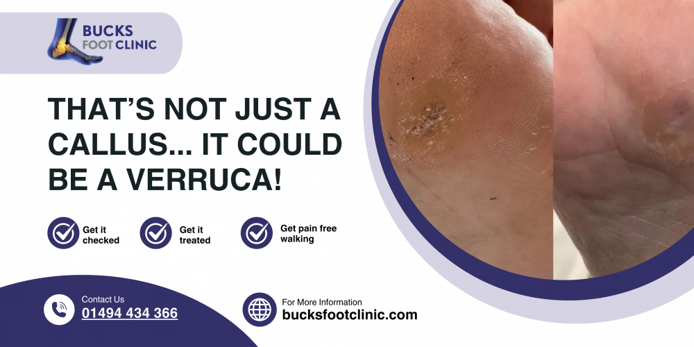 Verrucas on Feet: Causes, Symptoms, and Expert Treatments