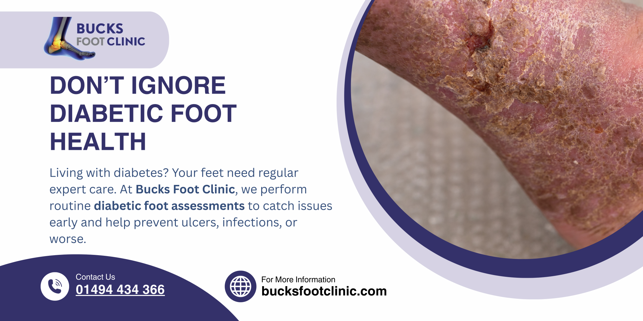 How Podiatrists Can Help with Corns: Relief, Treatment Prevention