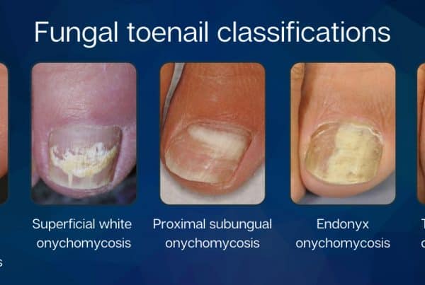 Dermatophytes and the Hidden Dangers for Toenail Health