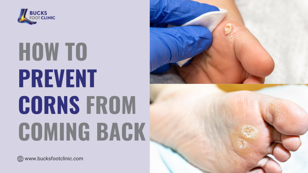 Corn Prevention Amersham – Expert Care at Bucks Foot Clinic