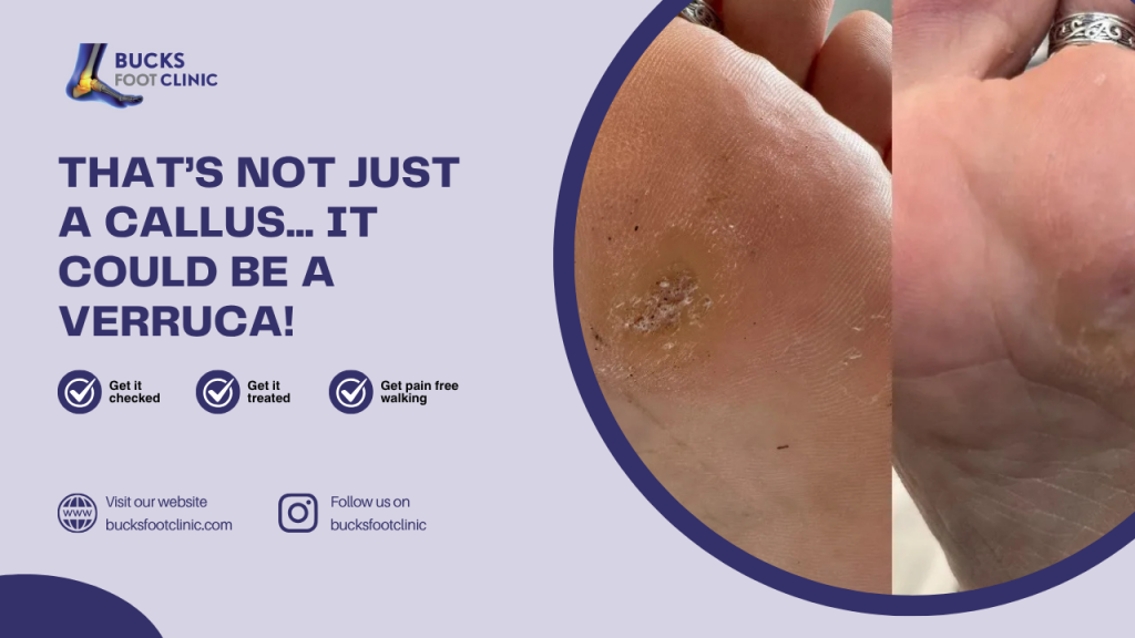 Verrucas on Feet: Causes, Symptoms, and Expert Treatments